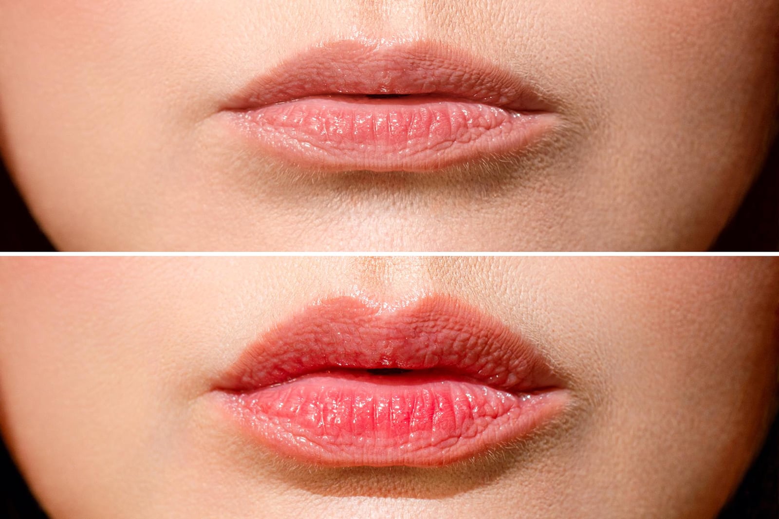 Lip Fillers Los Angeles - Natural Lip Filler Injections