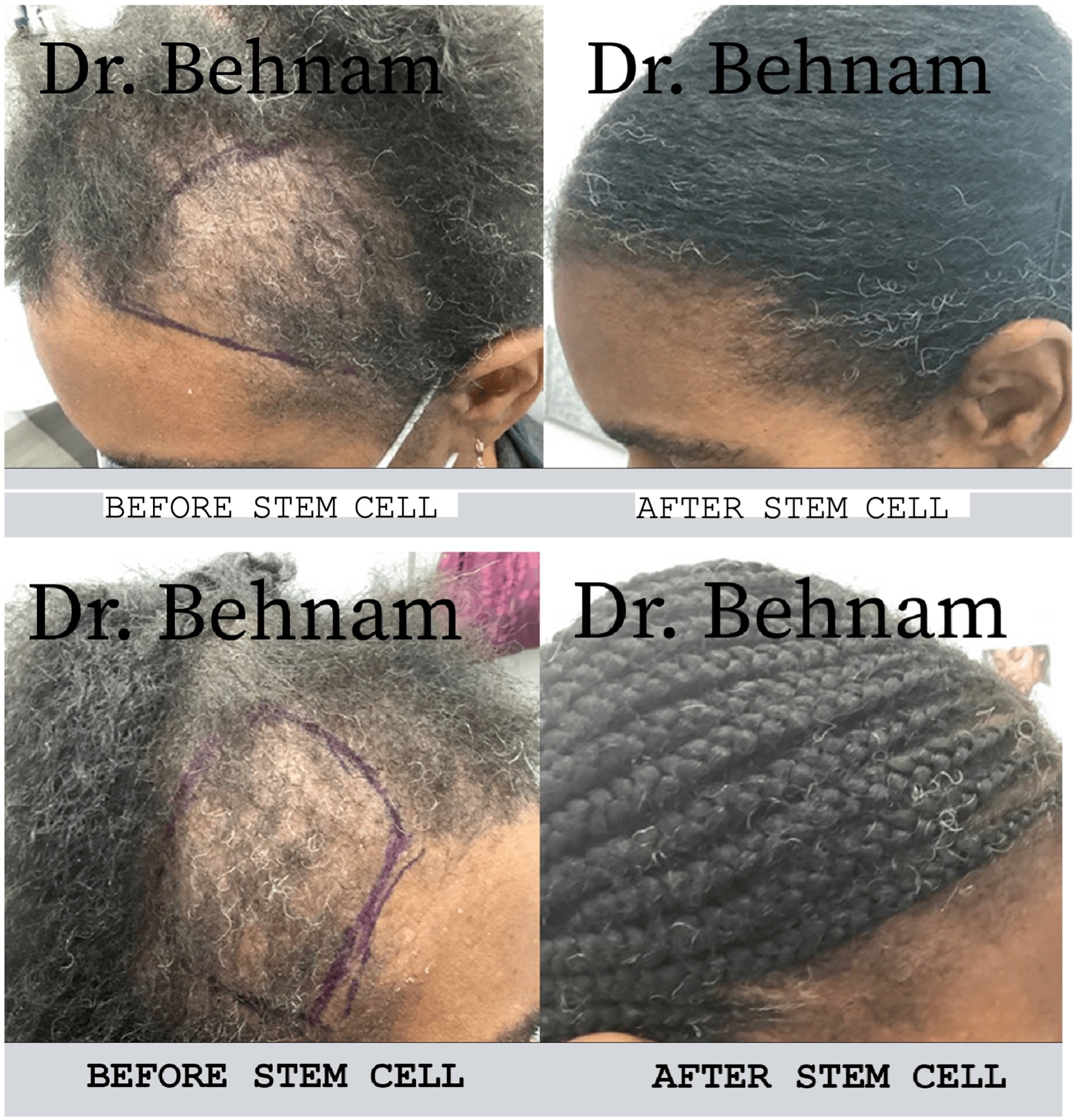 Stem Cell FAQ - Dr. Ben Behnam MD, FAAD - Best Dermatologist Los Angeles